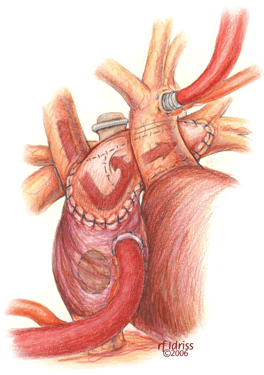 Modified Fontan | CTSNet