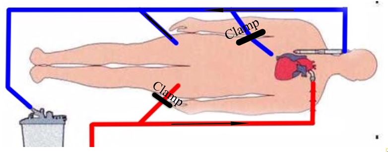 Pulmonary Valve Replacement in Adult Congenital Cardiac Surgery | CTSNet