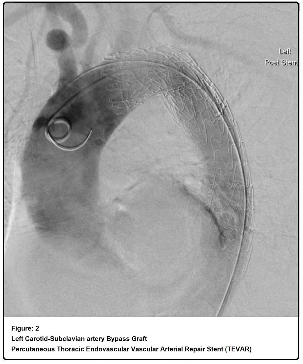 Aortic Root Remodelling, Debranching of Arch, Ascending Aorta ...