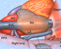 Minimally Invasive Surgical Correction of Scimitar Syndrome | CTSNet